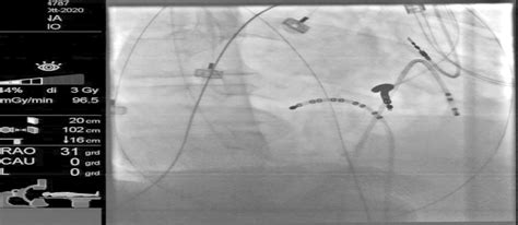 Epicardial Access Was Carried Out In Rao View Using A Mirror Image To Download Scientific