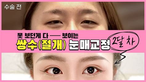 쌍수vlog 🔥쌍수 대성공🔥 수술 2달 차 완벽 후기 쌍꺼풀수술후관리 눈매교정 아웃라인 쌍수브이로그 성형브이로그 쌍꺼풀수술ㅣ쌍수 붓기 빠지는 과정
