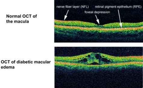Oct Macula Layers