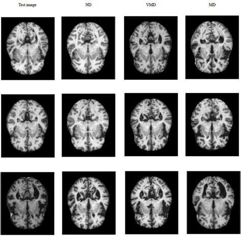 Figure 1 From Alzheimers Disease Diagnosis By Deep Learning Using Mri