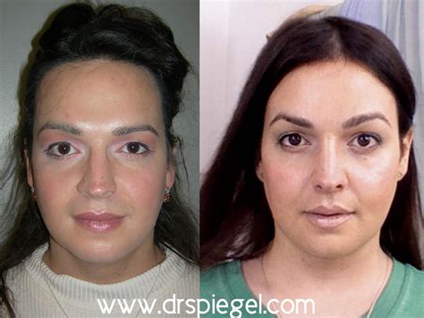 Transgender Surgeries Male To Female Popsugar Beauty
