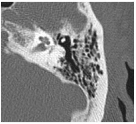 Temporal Bone Radiology Key