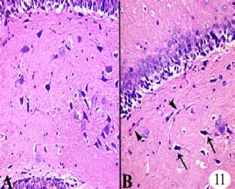 A Disturbed Arrangement And Reduction Of The Polymorphic Cell Layer