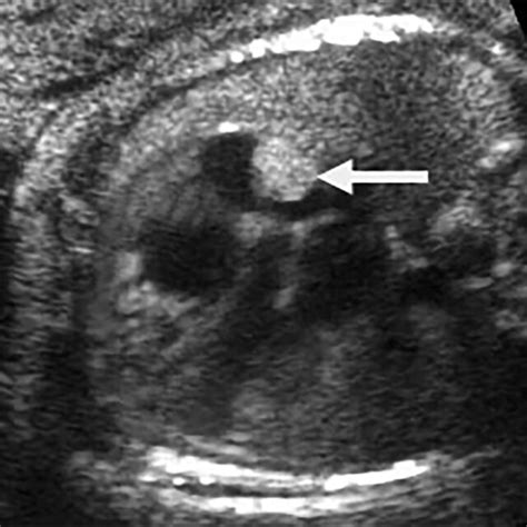 Case 1 Axial T2 Weighted Magnetic Resonance Image Showing A Brain