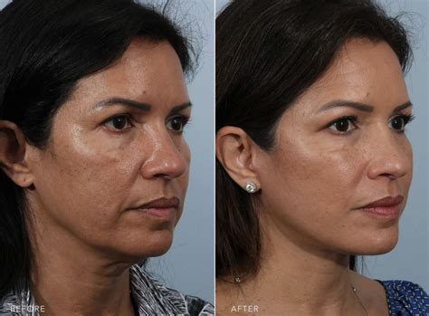 What Is The Best Alternative To A Facelift At Tayla Bruton Blog