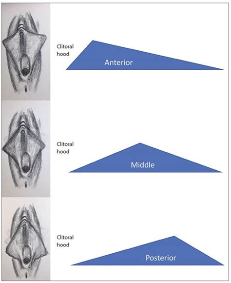 Labia Minora Reduction Before And After