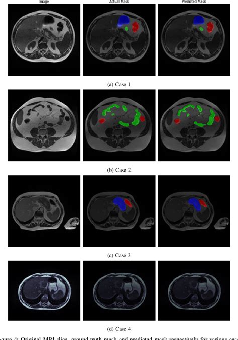 Figure 4 From Gastro Intestinal Tract Image Segmentation Using Edge U Net And U Net Vgg19