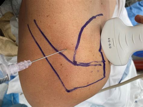 Arthroscopic And Open Decompression Of The Suprascapular Nerve Clinical Tree