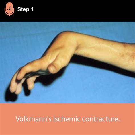 Turnbuckle Splint For Volkmann Ischemic Contracture At Tomas Jacobs Blog