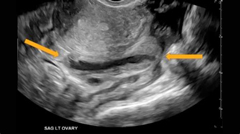 The Figo Classification System For Uterine Fibroids Review Of Mri Findings And Reporting Best