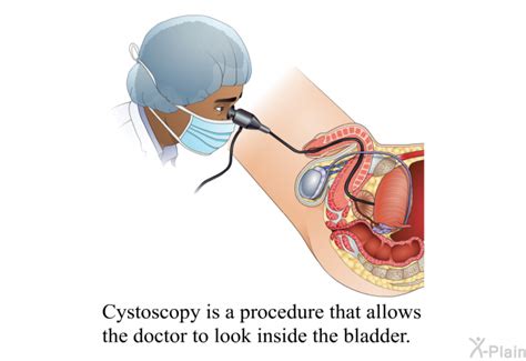 Cystoscopy Procedure