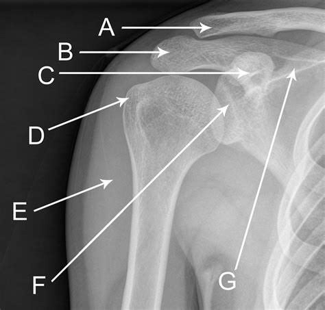 Shoulder X Ray Anatomy
