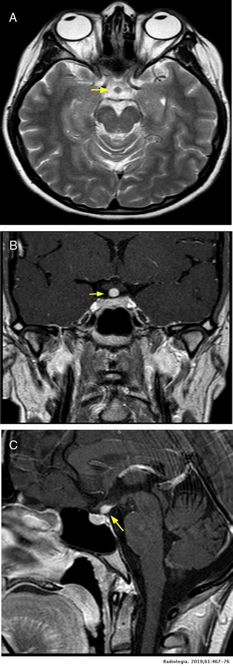 Región Selar Evaluación Mediante Resonancia Magnética De Lesiones