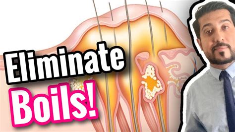 5 Quick Ways To Get Rid Of Boils On Skin How To Treat A Boil Fast