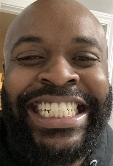 22 Months Later Braces Are Finally Off R Braces