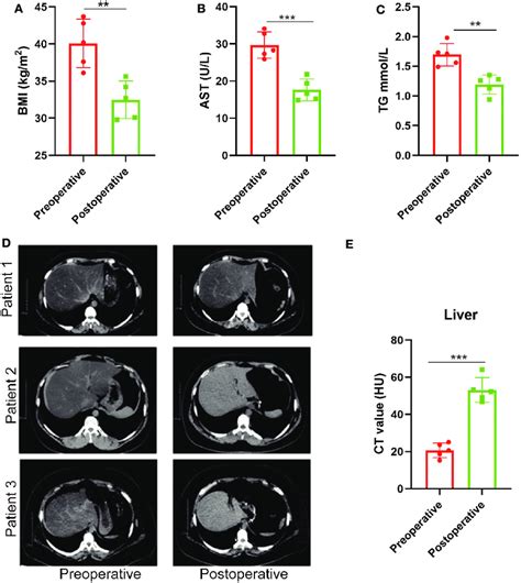Nafld Is Relieved After Sg In Patients With Obesity A C Bmi Values