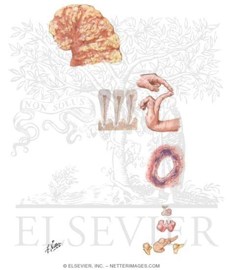 Pathology And Clinical Manifestations Of Hyperparathyroidism