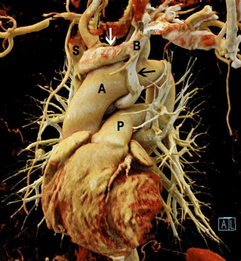 Cinematic Rendering From Anterior Perspective Shows The Left Download Scientific Diagram