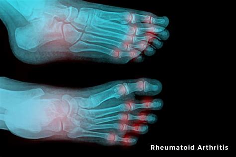 Different Types Of Arthritis Feet First Clinic