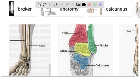 Solved What Do The Femoral Condyles Meet With On The Tibia