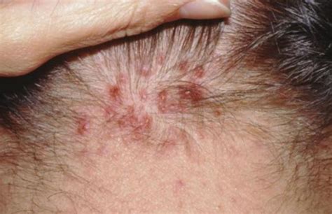 Pictures Causes And Treating Red Bumps On Scalp Healthality