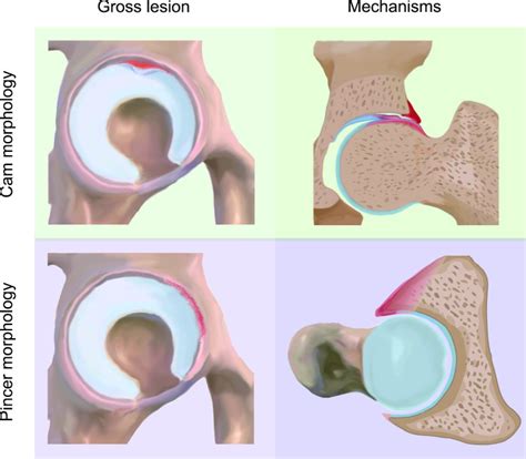 Current Understanding Of Articular Cartilage Lesions In