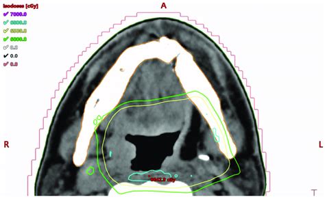 Absorbed Dose Distribution In Mandible Download Scientific Diagram