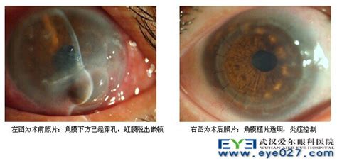 类风湿引起角膜穿孔 实施角膜移植术后挽救视力 角膜病介绍