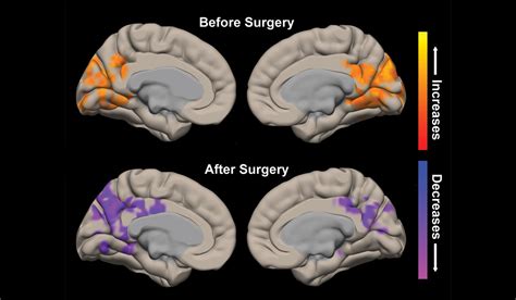 Temporal Lobe Resection Improves Brain Connectivity Vanderbilt Discover