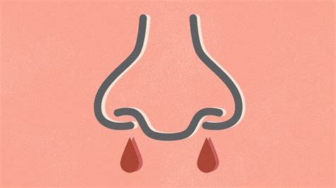 Nose Bleeding নাক দিয়ে রক্ত পড়ার কারণ লক্ষণ ও আপদকালীন স্ব