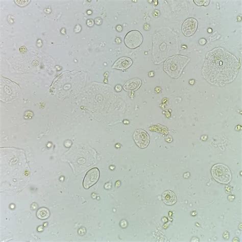 Transitional Epithelial Cells Medlabbuddy