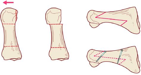 Cirugía De Juanetes Hallux Valgus Indicaciones Osteotomías Y Beneficios Frente A Otras