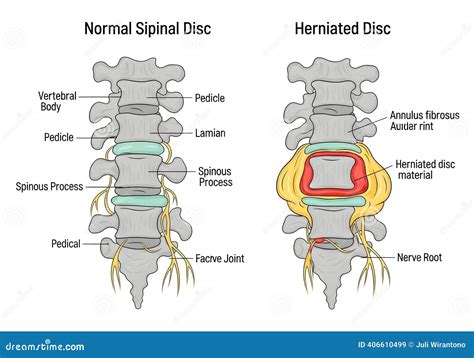 Normal Disc And Spinal Disc Herniation In Cervical Vertebrae Cartoon