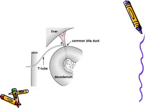 T Tabung Cholangiogram Ppt