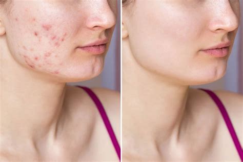 Clear Acne Get Rid For Good Biom Probiotics