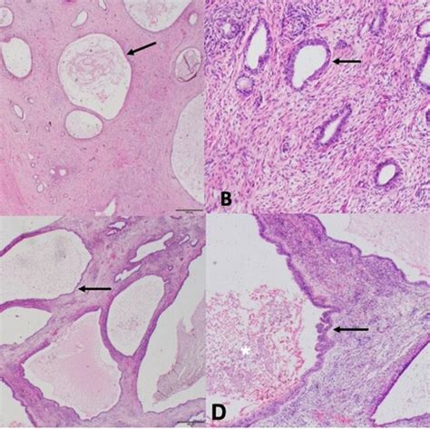 A Microphotograph Depicting Accessory Uterine Masses With The Download Scientific Diagram