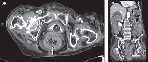 Adult Rectosigmoid Junction Intussusception Presenting With Rectal Prolapse Pmc