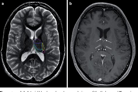 Differential Diagnosis Of Bilateral Thalamic Lesions Semantic Scholar