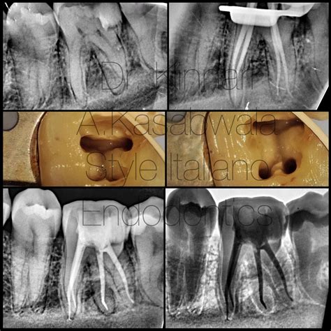 Radix Entomolaris A Case Series Style Italiano Endodontics