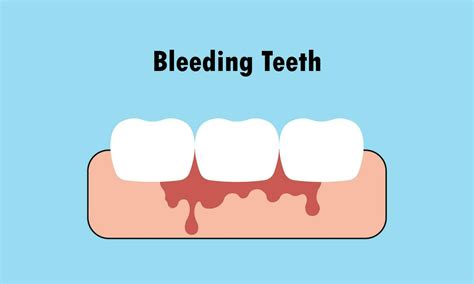 Bleeding White Teeth While Cleaning Because Brushing With Toothbrush Illustration Cartoon