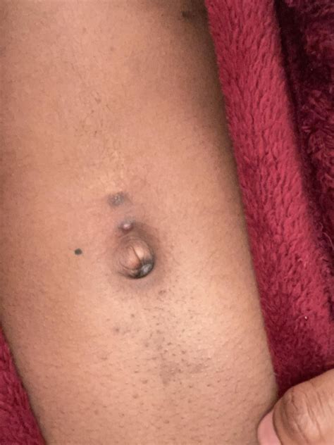 Help Is This A Keloid Rpiercing