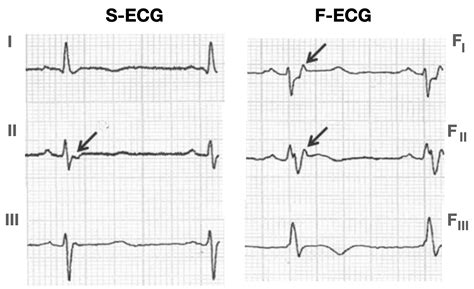 Epsilon Wave • Litfl Medical Blog • Ecg Library Basics