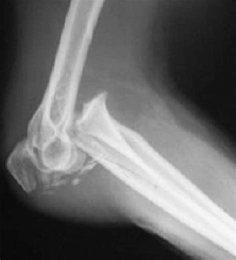 Preoperative Radiograph Of Type Iiib Olecranon Fracture Download Scientific Diagram