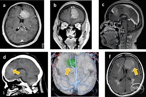 【神外早8点 手术有新译】内镜辅助的对侧半球间入路小骨窗开颅手术治疗镰旁脑膜瘤 脑医汇