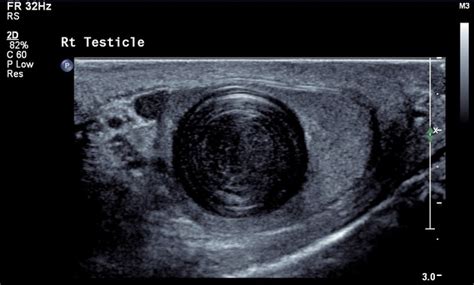 Scrotal Cyst Treatment