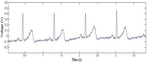 ECG Signal Without Filtering In MATLAB Download Scientific Diagram