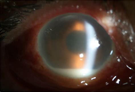 Right Eye Shows Conjunctival Injection Corneal Edema With Infiltrates Download Scientific