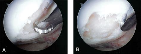Microfracture Musculoskeletal Key