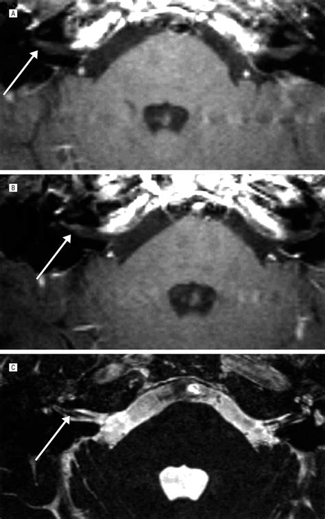 Acute Vestibular Neuritis Visualized By 3 T Magnetic Resonance Imaging