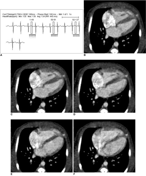 Multi Phase Prospective Ecg Triggered Sequential Ct Scan A Extended